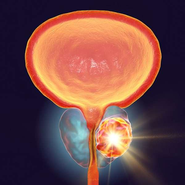 Cancro da Próstata - Instituto de Urologia Oncológica